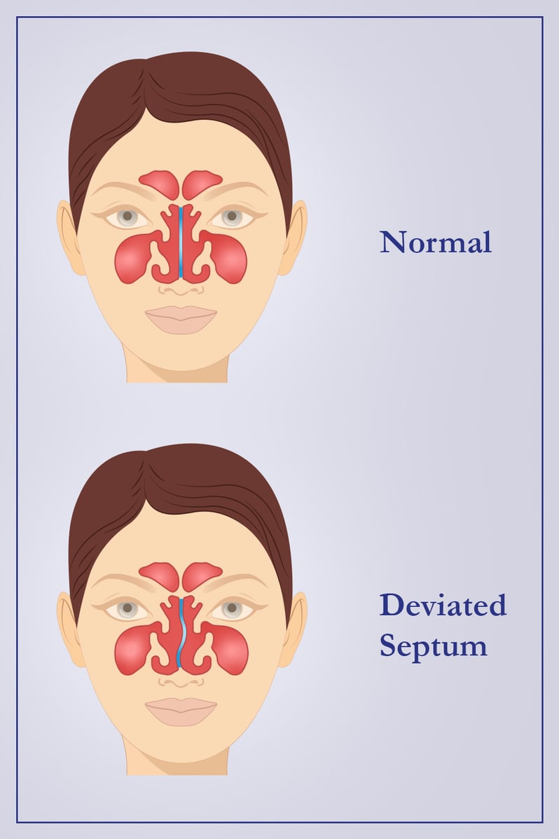 Functional Rhinoplasty: Breathe Better and Improve Nasal Function