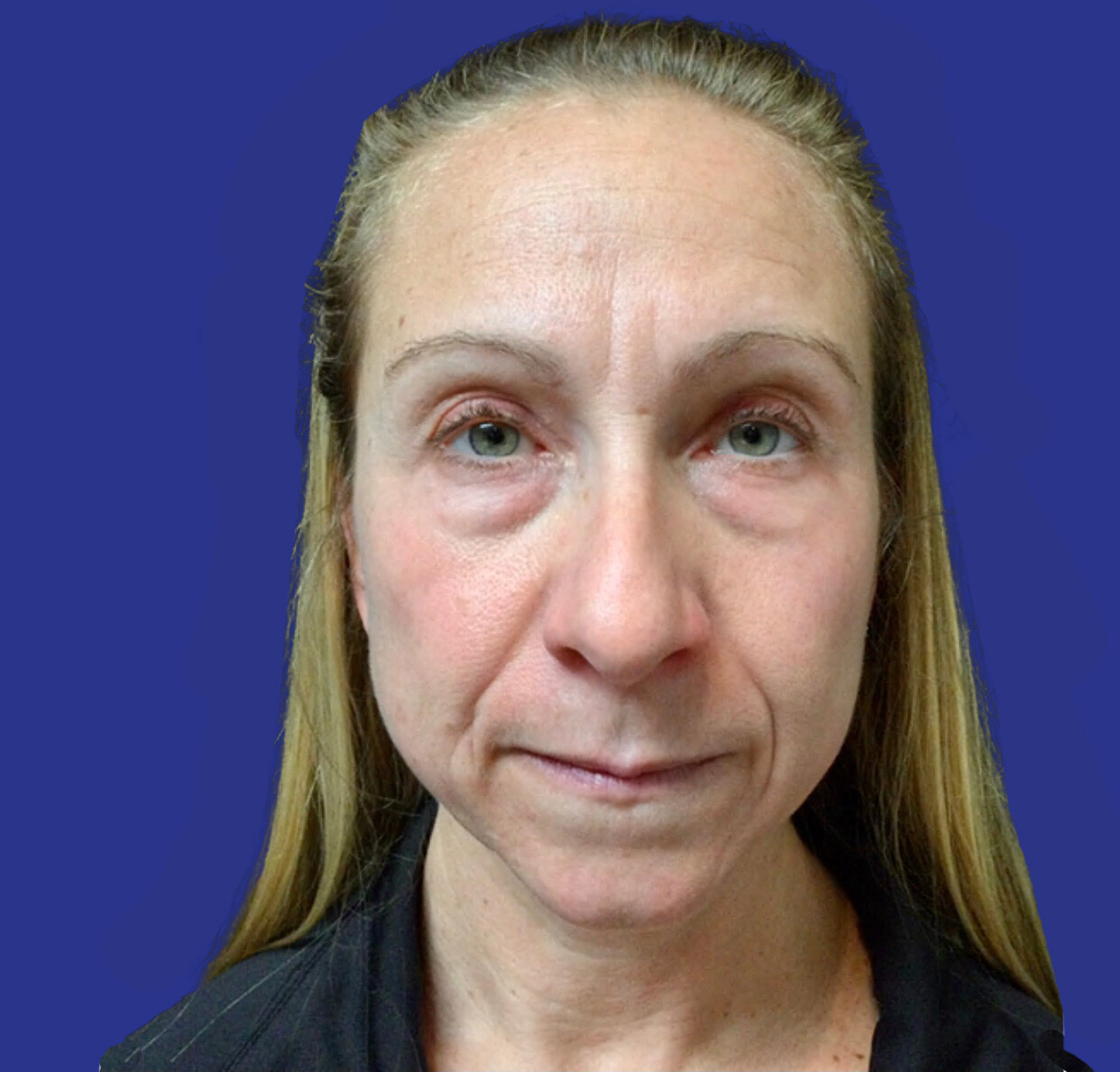 Sebaceous Cyst Removal: Understanding Your Options