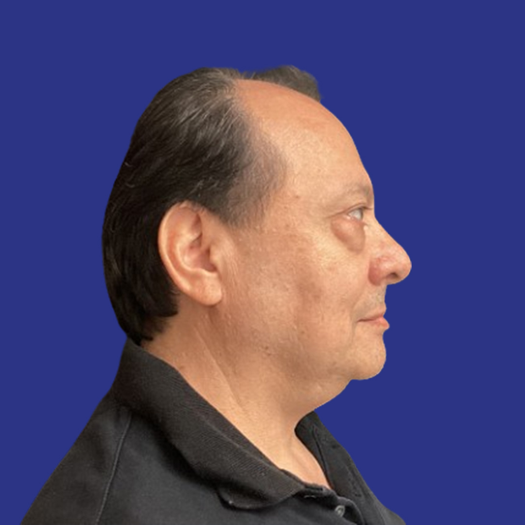 Say Goodbye to Sagging Eyelids with Our Blepharoplasty Procedure